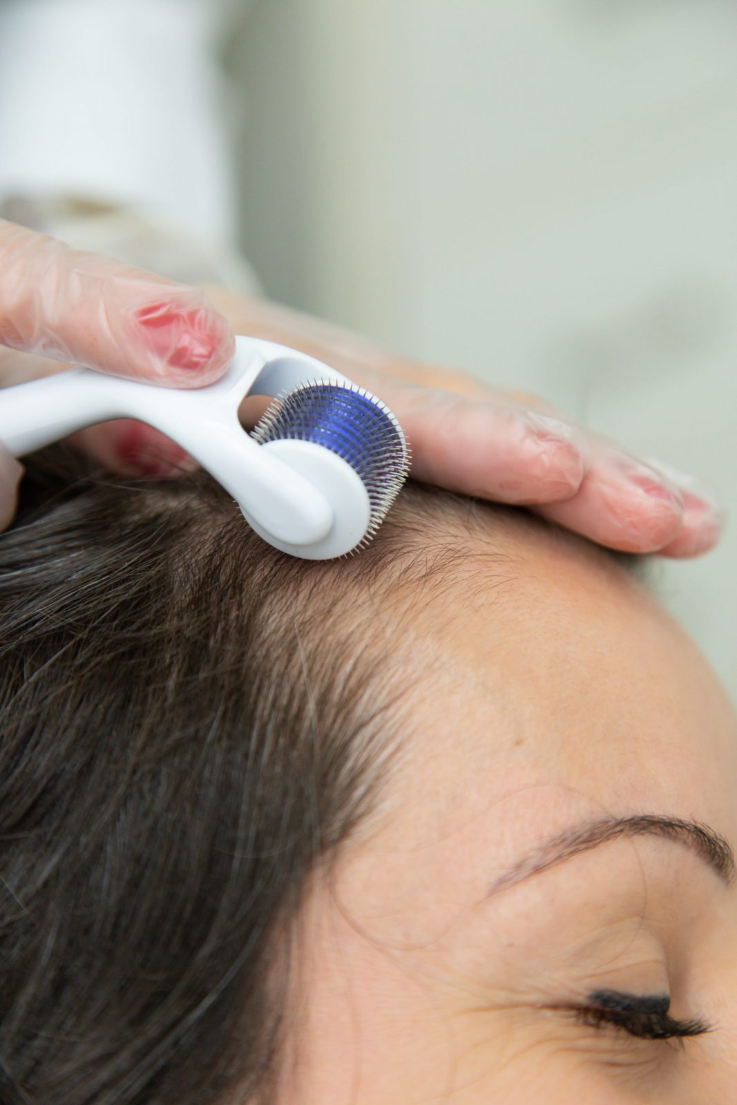 Microagulhamento - Persona Estética